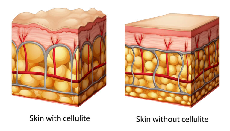 Cellulite on Legs – Can You Get Rid of It?