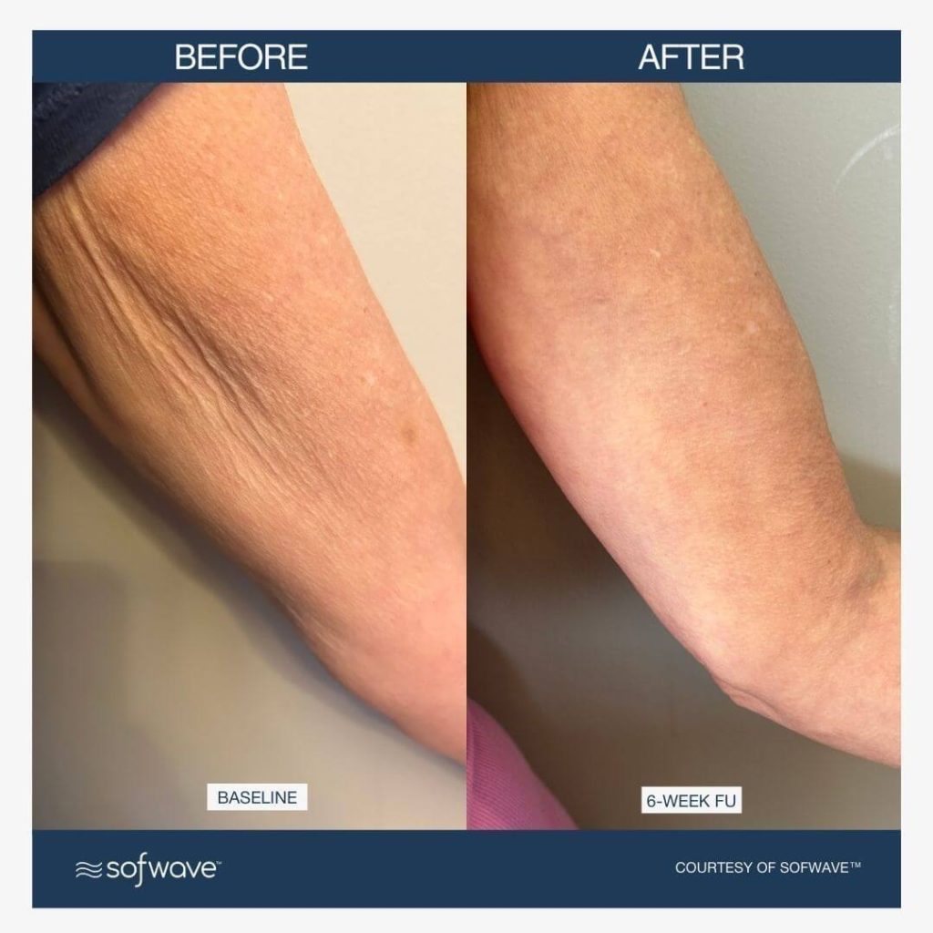 Ozempic Arms: How to Address and Treat Sagging Skin