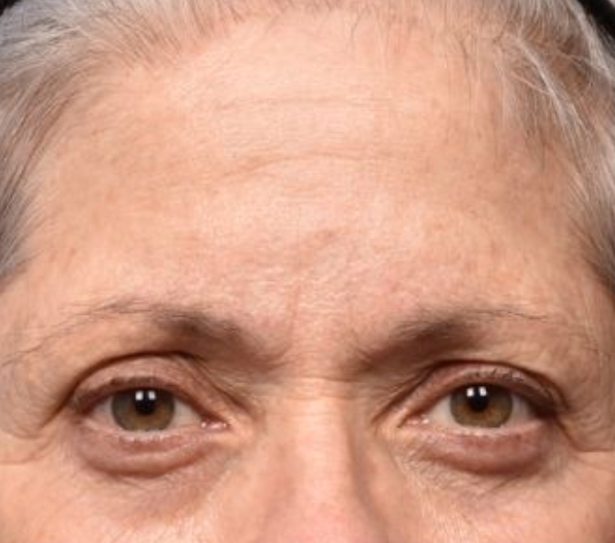 Sofwave Before and After Results