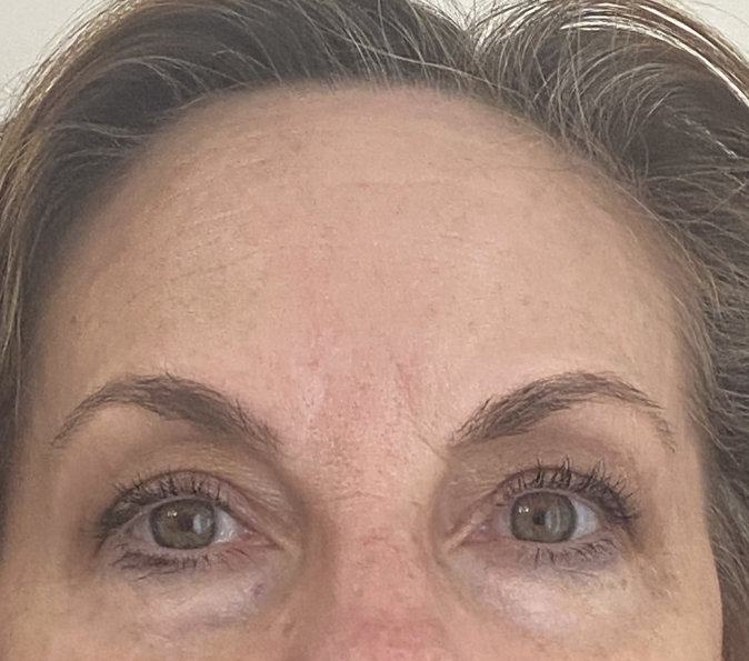 Discover Sofwave™ Facial Treatments