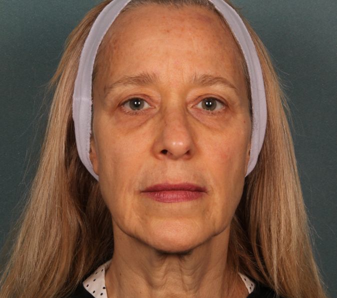 Sofwave™ SUPERB™ Technology