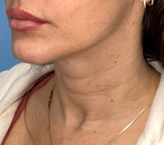 Sofwave Before and After Results