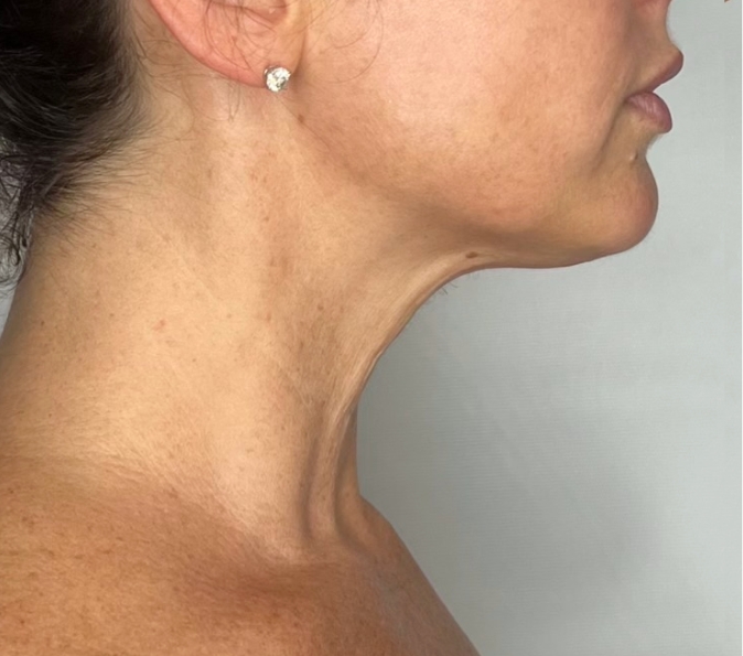 Discover Sofwave™ Facial Treatments