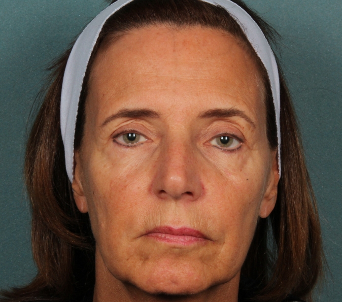 myWave USA - Sofwave