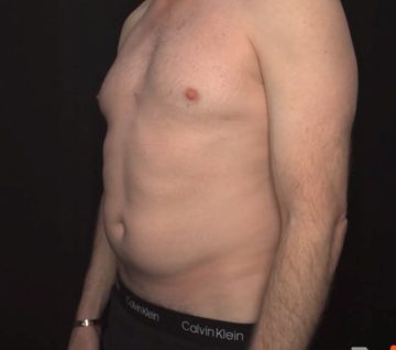 Pure Impact™ by Sofwave