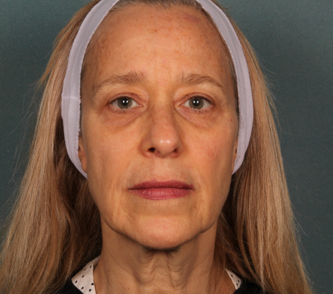 Discover Sofwave™ Facial Treatments