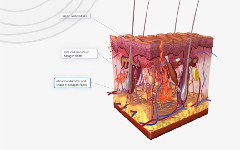 How Can Skin Laxity Be Reduced?
