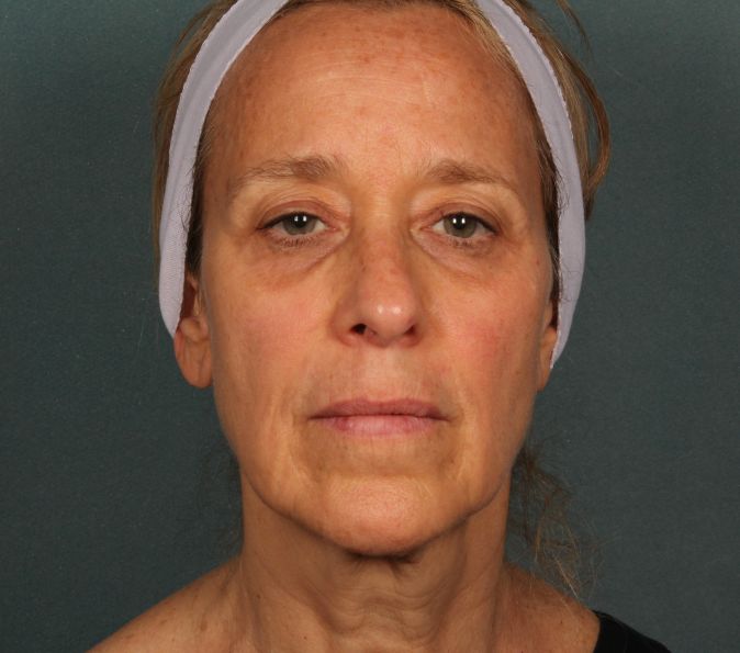 Sofwave™ SUPERB™ Technology