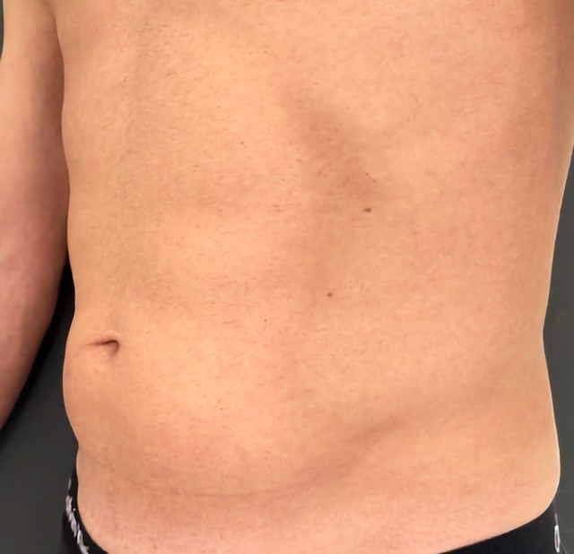 Sofwave Body Treatments