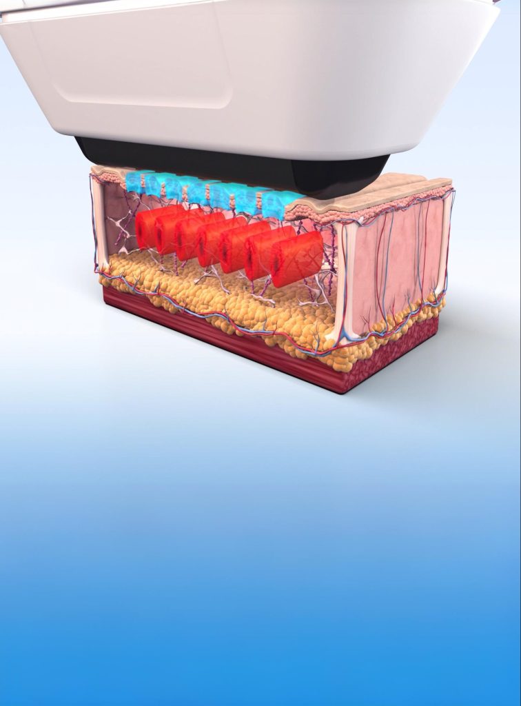 Sofwave™ SUPERB™ Technology