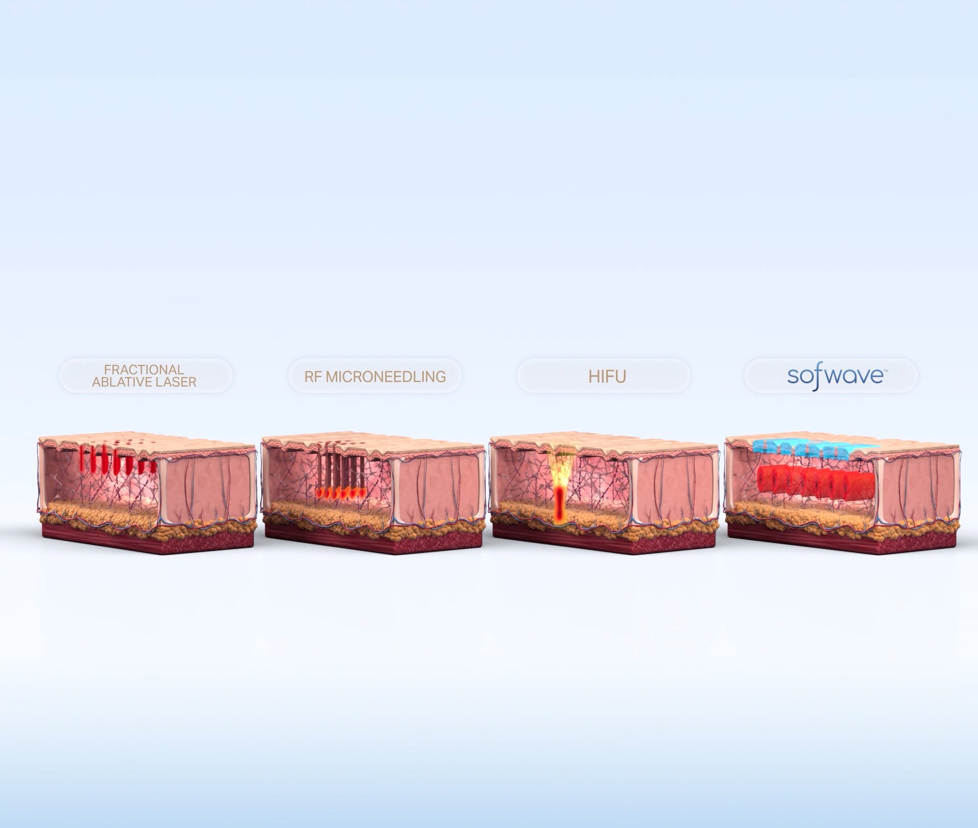 Sofwave™ SUPERB™ Technology