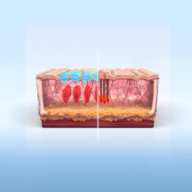 Sofwave™ SUPERB™ Technology