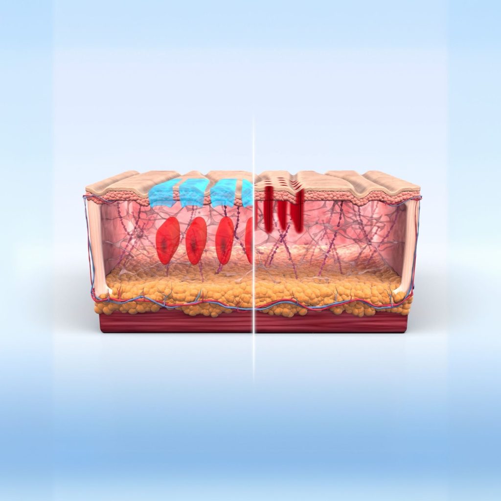 Sofwave™ SUPERB™ Technology