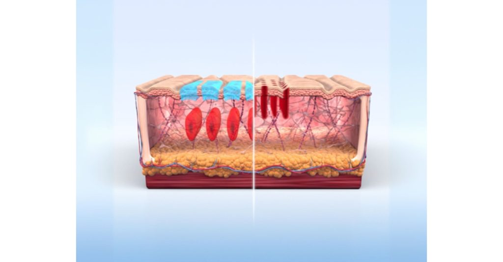 Cellulite vs Stretch Marks: Science & FDA-Cleared Solutions