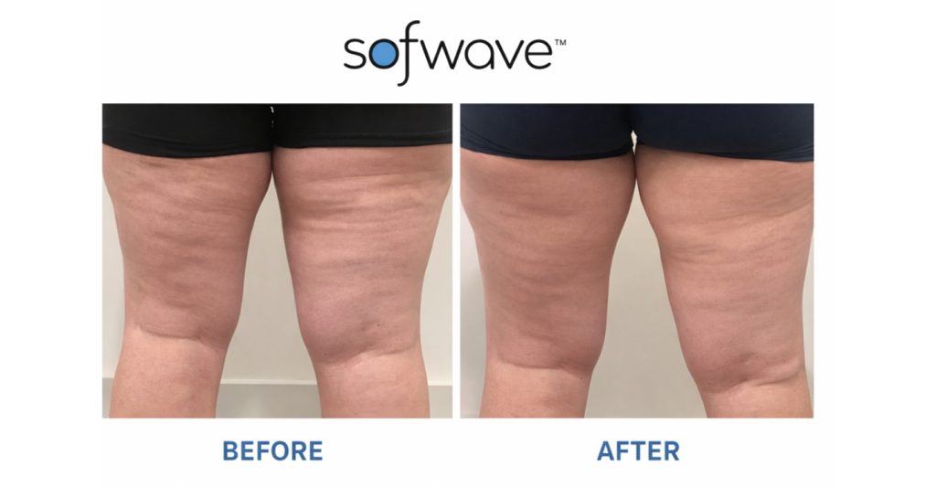 Ozempic Legs: Why GLP-1 Weight Loss Changes Thighs & Cellulite